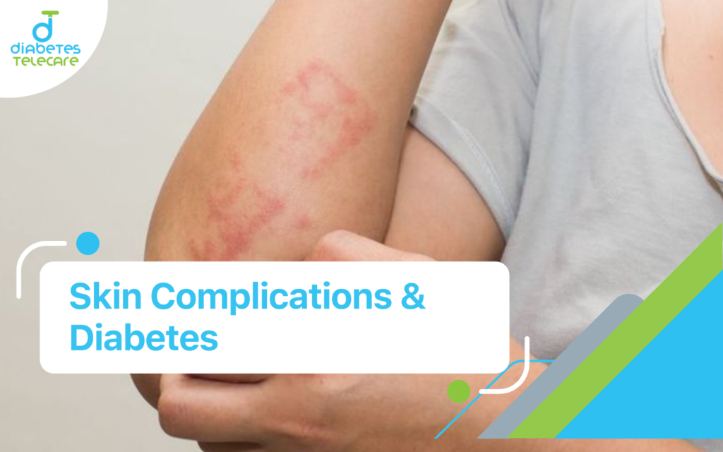 Diabetes and Skin - Understanding Complications and Care Tips